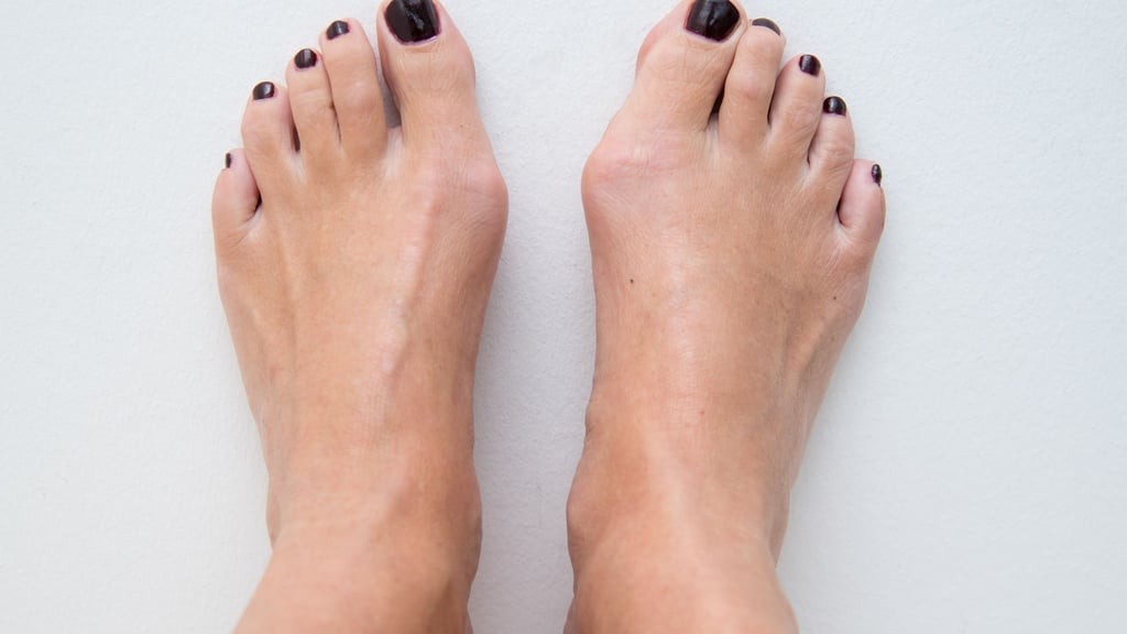 Hallux valgus: Was tun, wenn der große Zeh in Schieflage gerät?